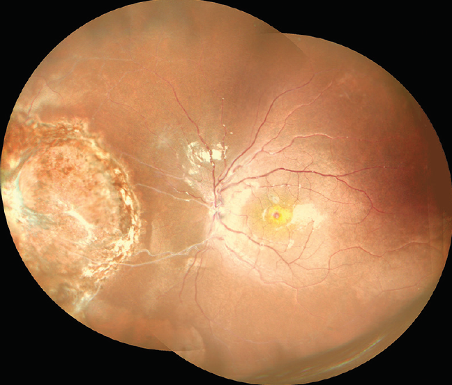 Widefield Multimodal Imaging - Retina Today