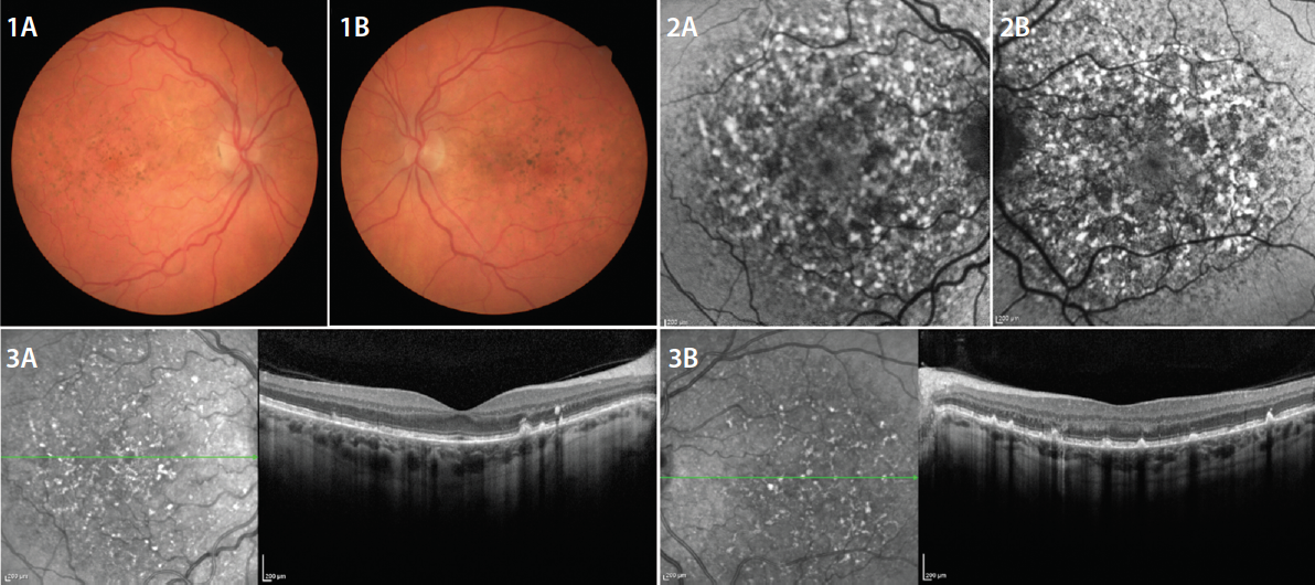 A Primer on Pentosan Polysulfate Sodium Maculopathy - Retina Today