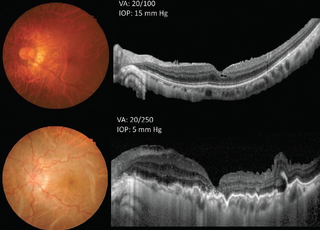 Hypotony Maculopathy After Phacoemulsification - Retina Today