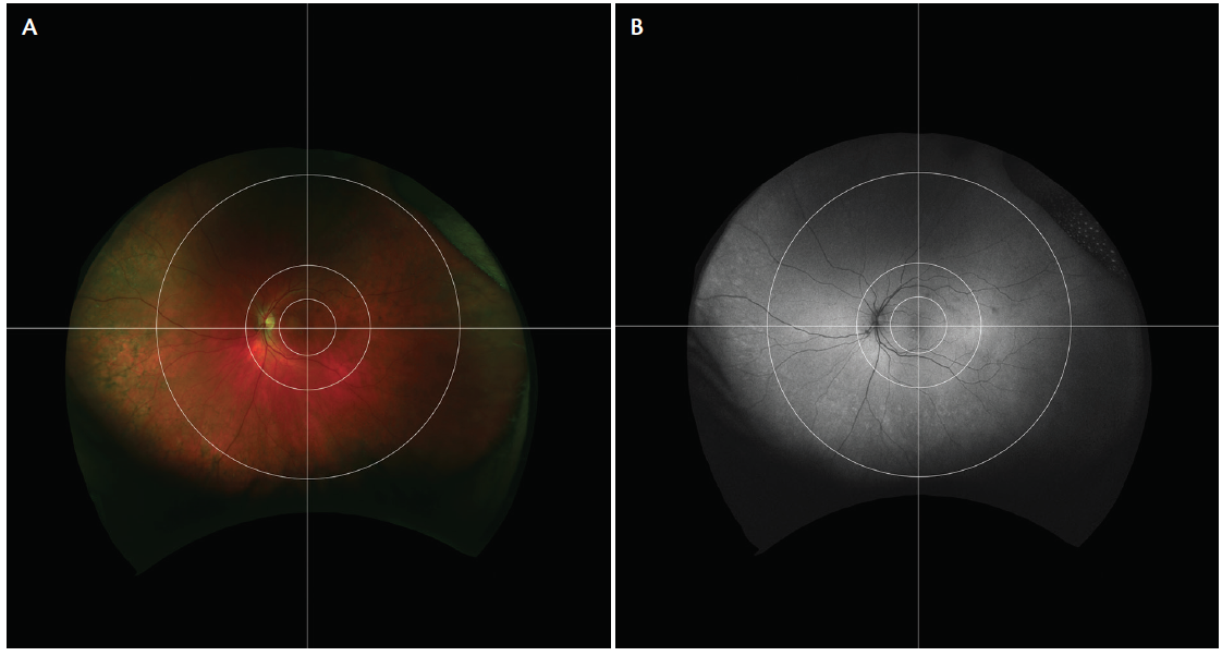 Ultra-Widefield Imaging for Age-Related Macular Degeneration - Retina Today
