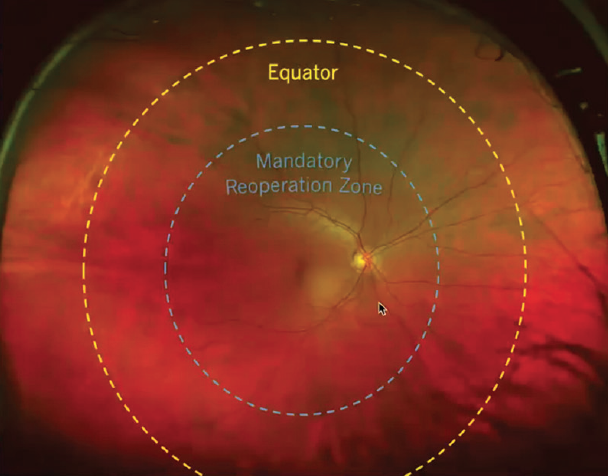 GUARD Against PVR: Methotrexate for Proliferative Vitreoretinopathy ...