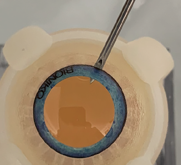 Techniques for In-Office Vitreoretinal Procedures - Retina Today