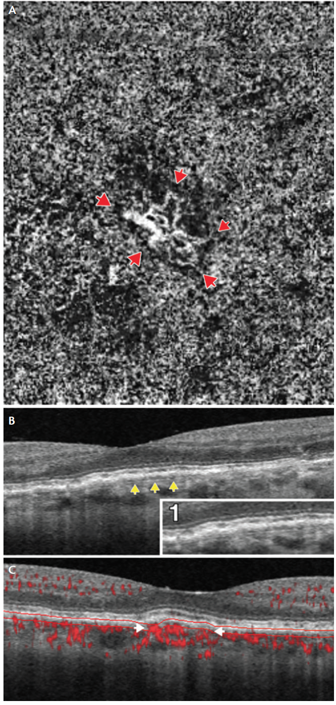 OCT Angiography in Nonexudative Age-Related Macular Degeneration ...