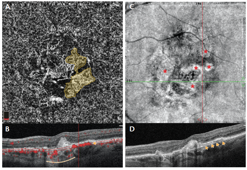 OCT Angiography in Nonexudative Age-Related Macular Degeneration ...