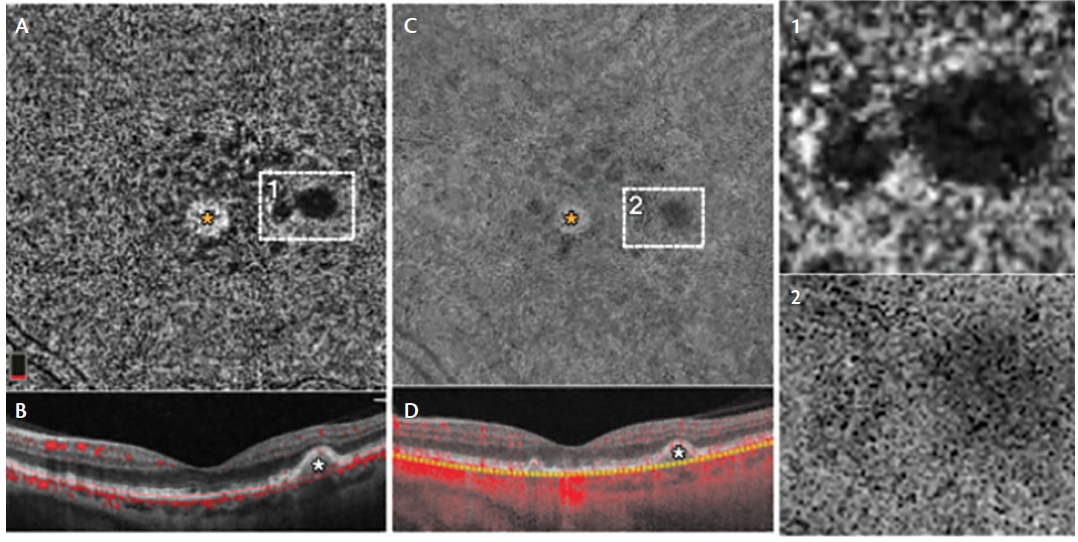 OCT Angiography in Nonexudative Age-Related Macular Degeneration ...