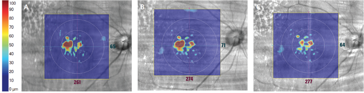 Photobiomodulation as a Treatment in Dry AMD - Retina Today